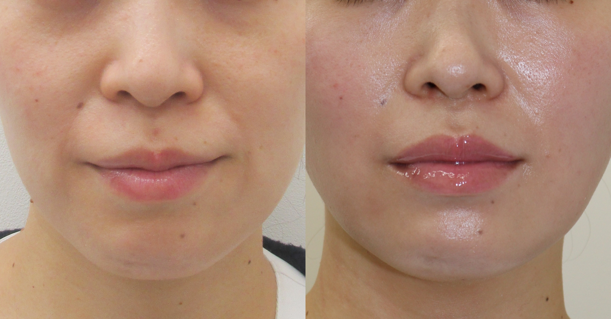 「聡 橋本」「Hari texture」「Sagging」「Wrinkles」「pores」「Collagen booster ...