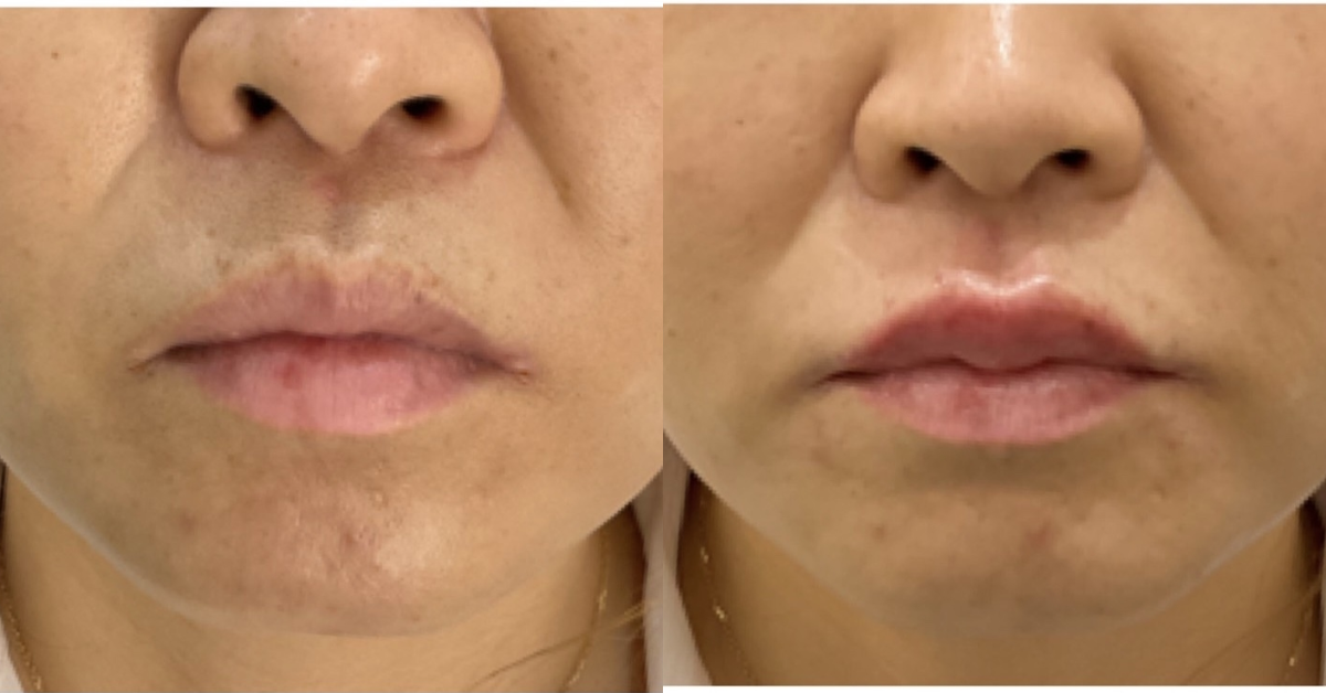 「律子 前原」「labios」「Ácido hialurónico/Inyección de ácido hialurónico」の ...